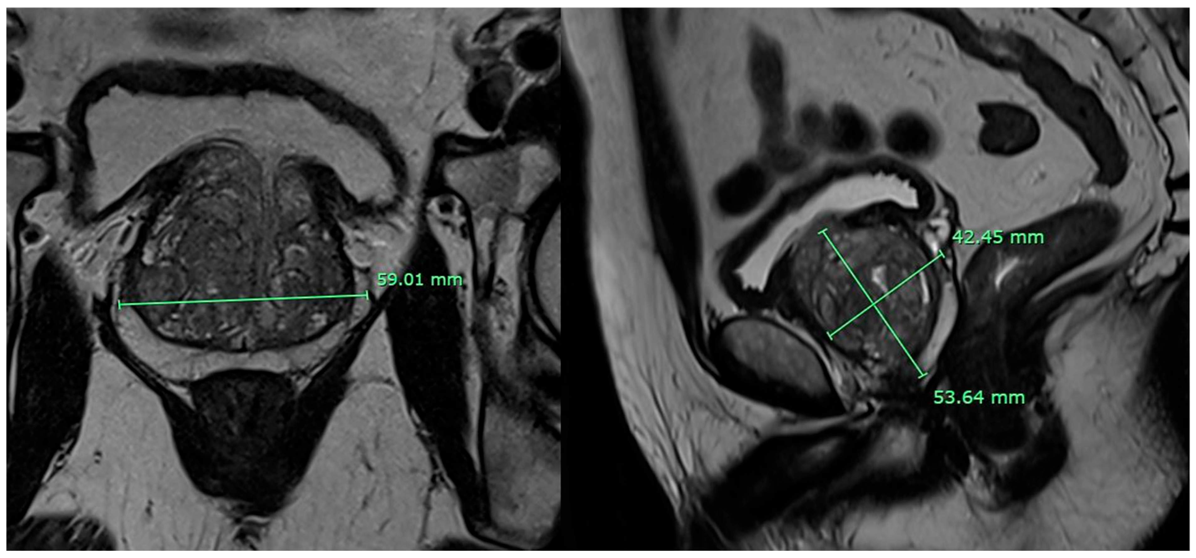 Diagnostic and Clinical Impact of Imaging Modality on PSA Density: TRUS ...