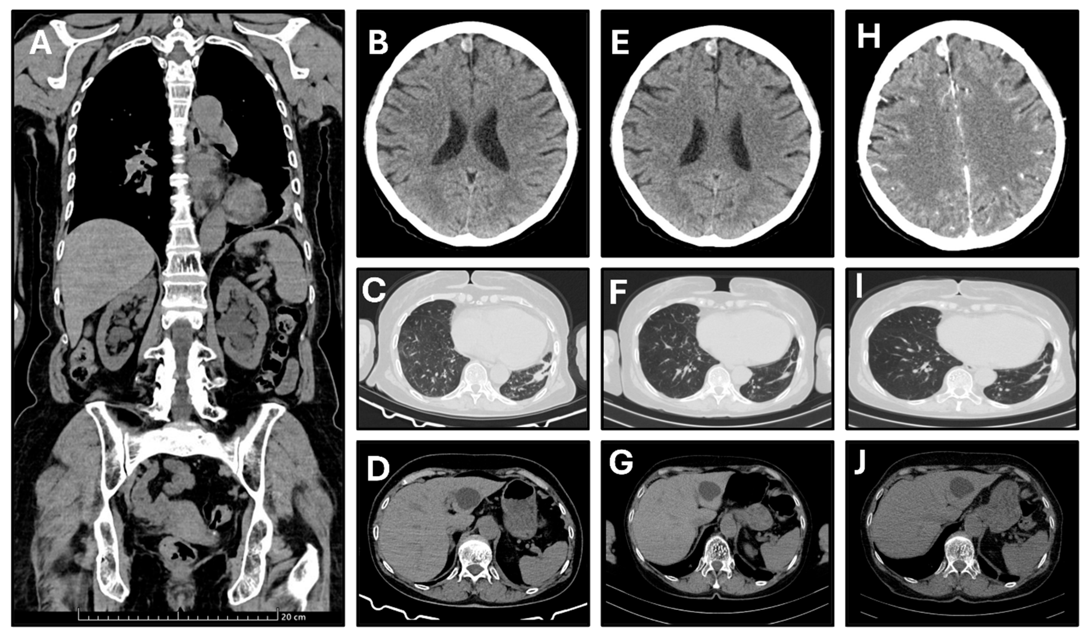 A Case of Primary EGFR T790M Mutation in Treatment-Naïve Advanced NSCLC ...