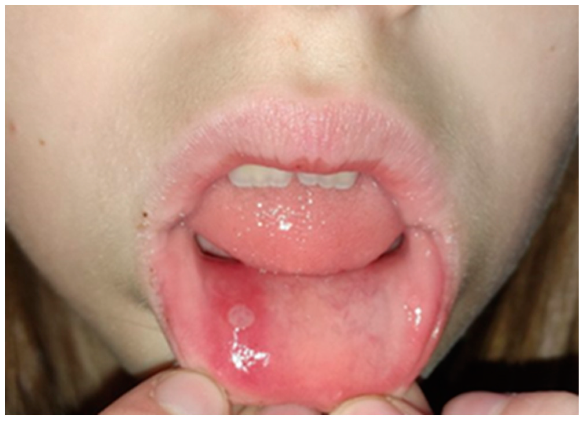 Dentistry Journal Free Full Text Oral Mucosal Lesions In Childhood Dentistry Journal Free Full Text Oral Mucosal Lesions In Childhood