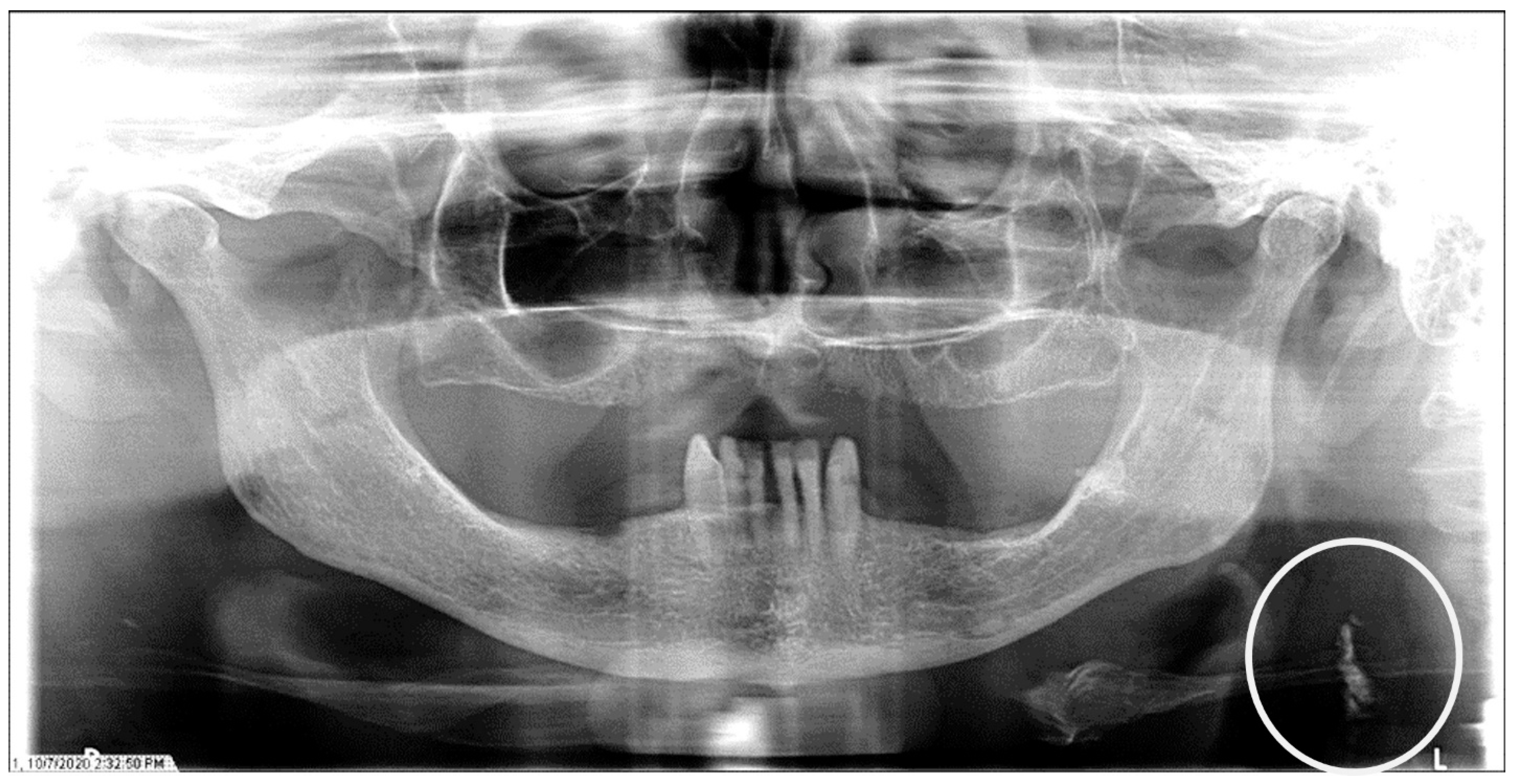 Carotid Artery Surgery Carotid Artery Surgery