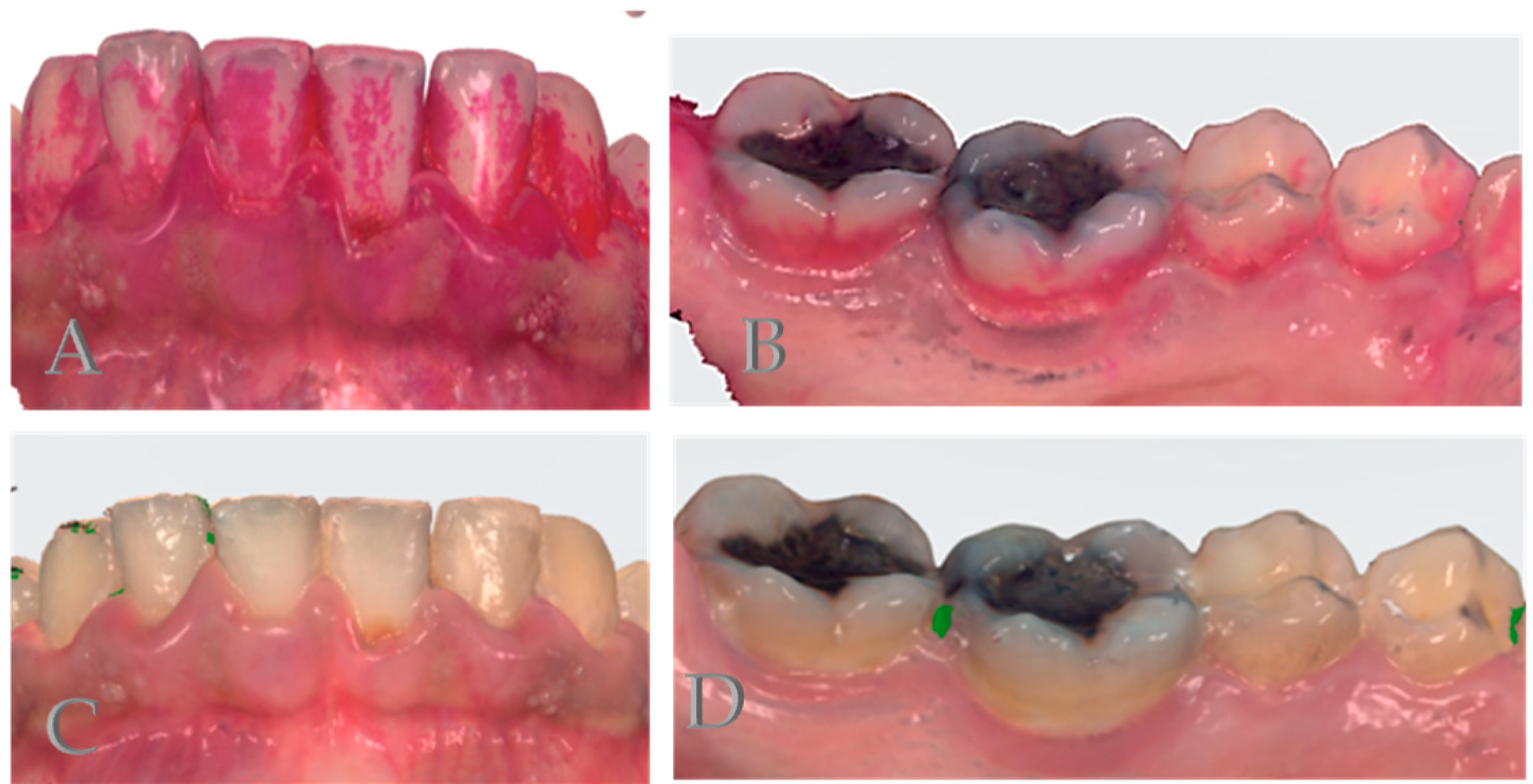 Level of Agreement Between Plaque Detection with Clinical Assessment and Assessment on Intraoral ...