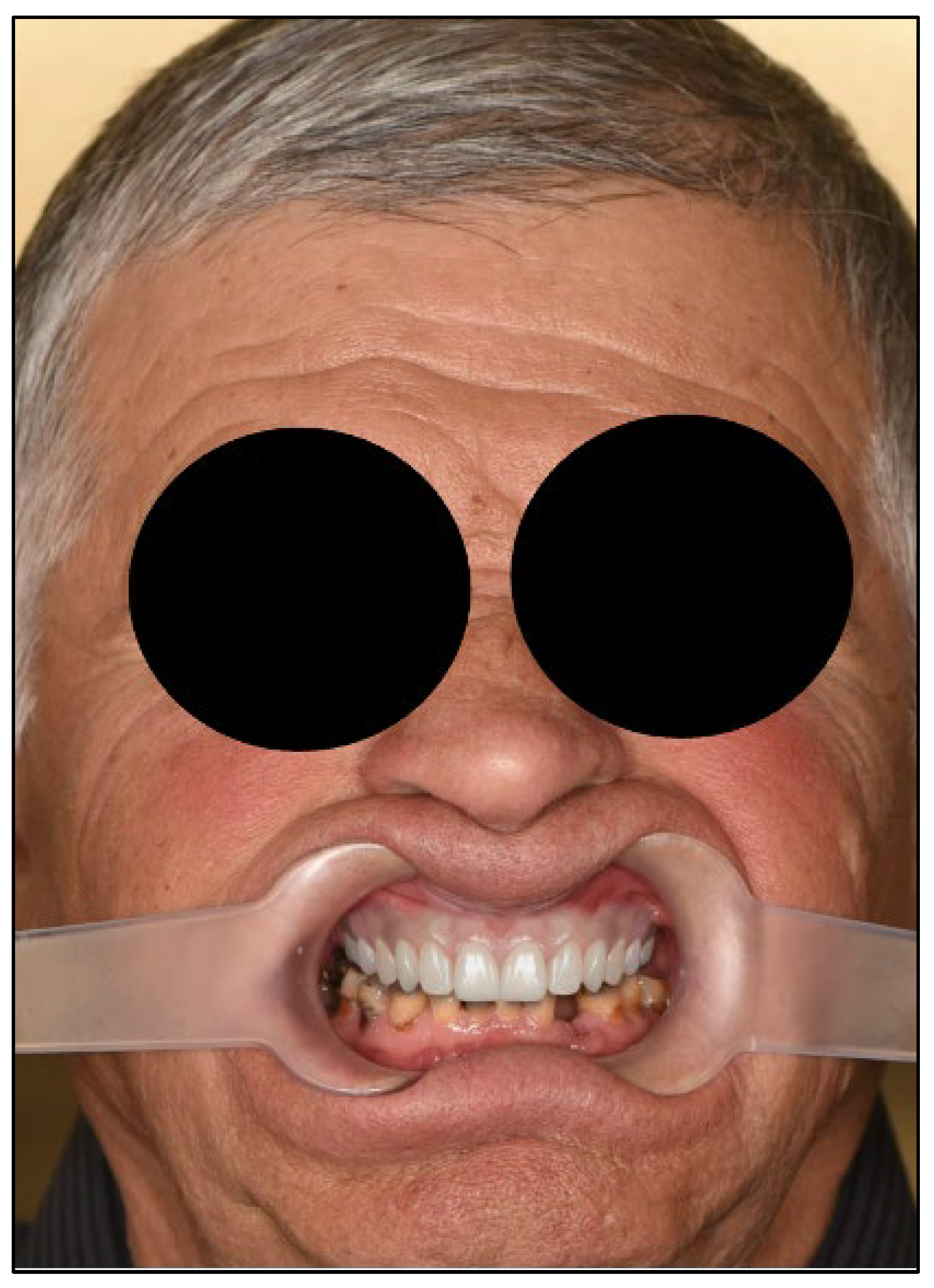 Facially Driven Full-Arch Implant Rehabilitation with Stackable ...