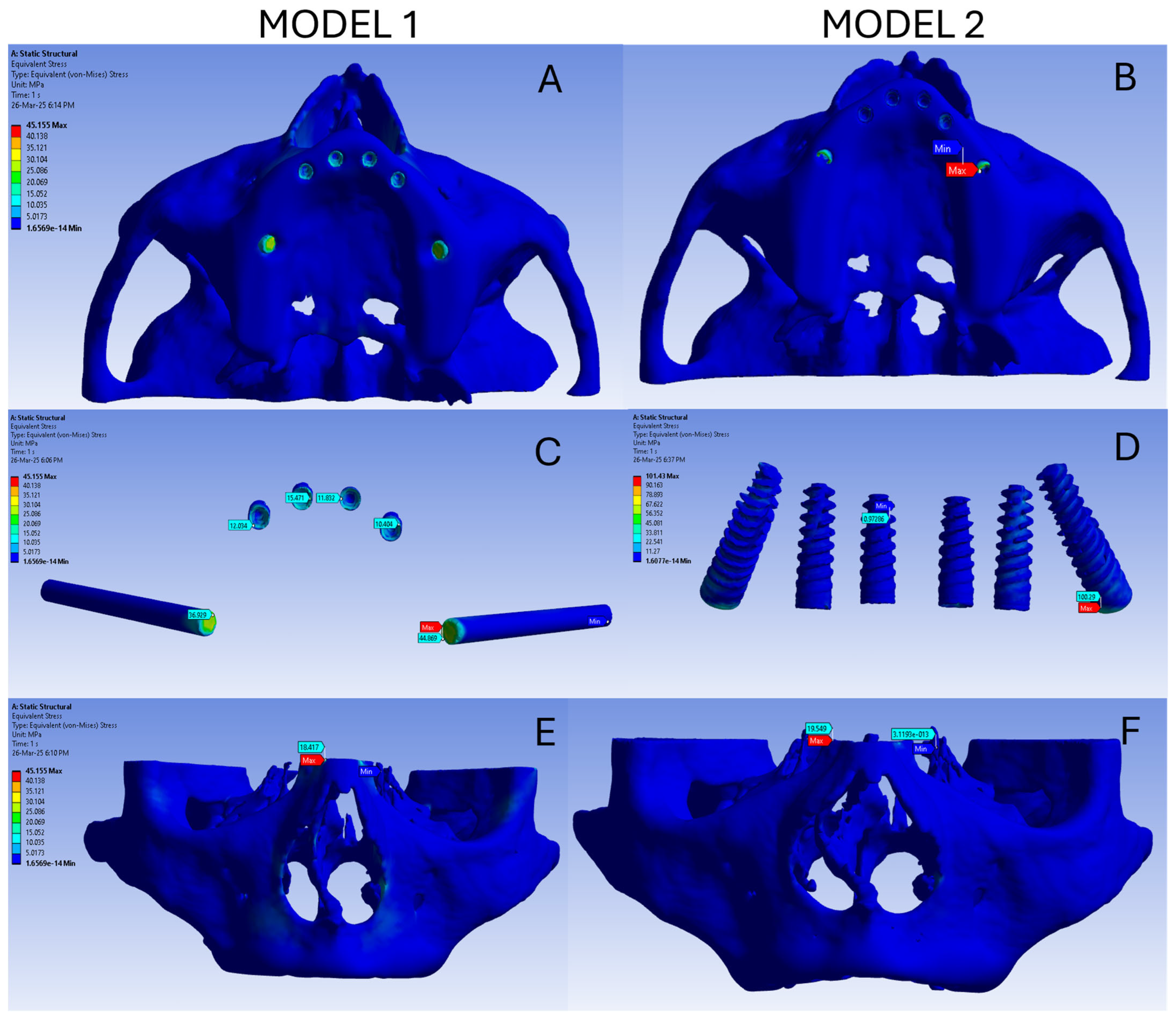 Biomechanical Comparative Evaluation of Atrophic Edentulous Maxilla ...