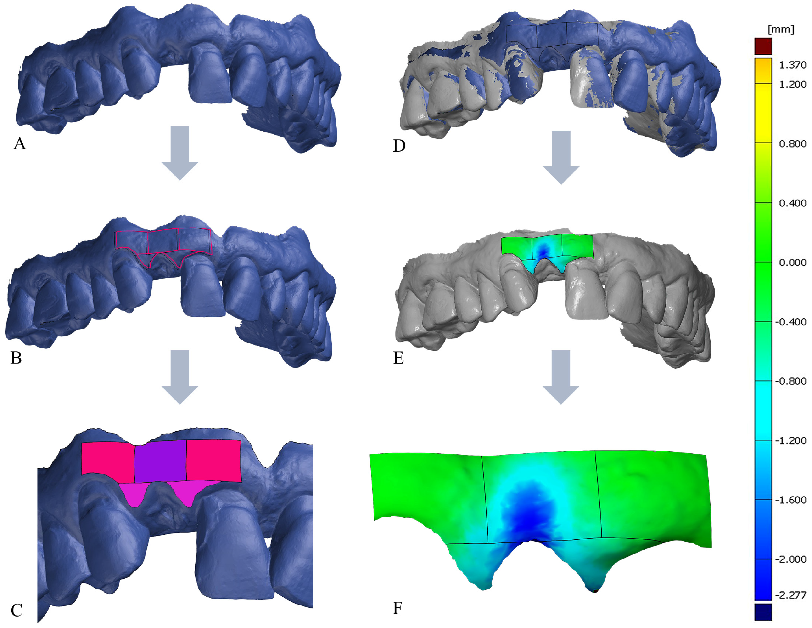 Impact of Conventional vs. Vertical Tooth Extraction on Three ...
