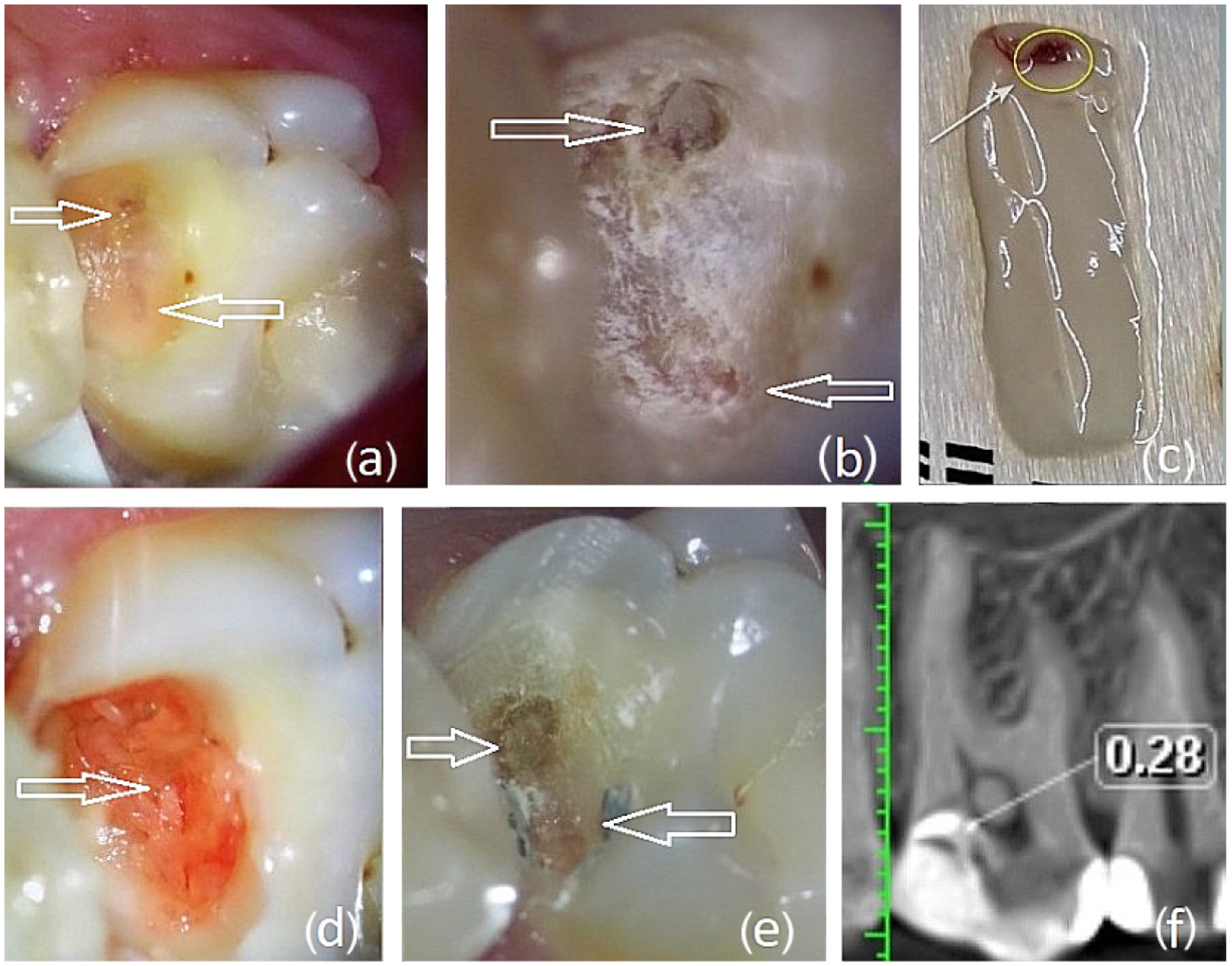 Direct Pulp Capping of Dental Pulp with Two Different Autologous ...