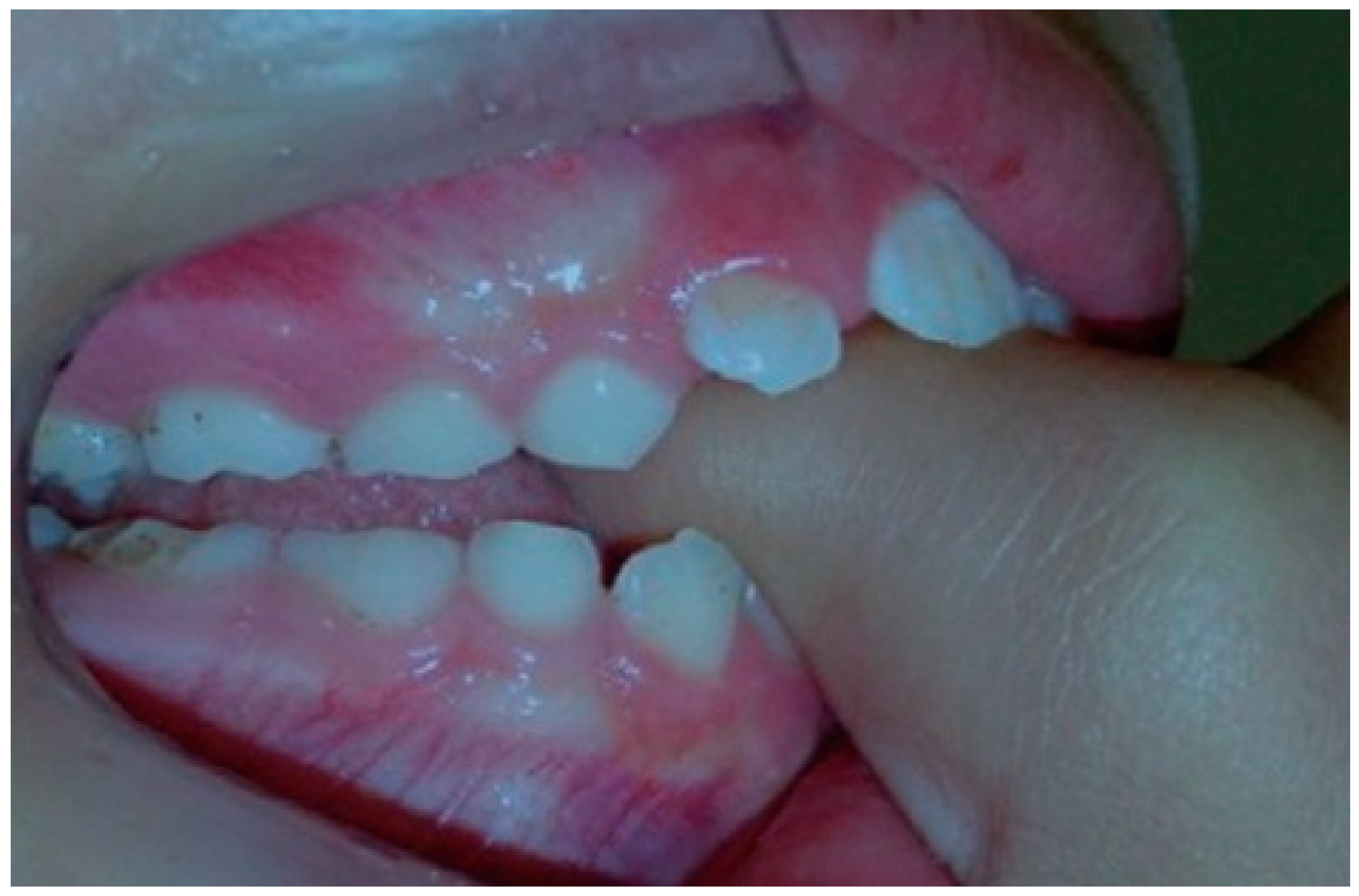 The Role of Digit- and Pacifier-Sucking Habits on Malocclusion ...