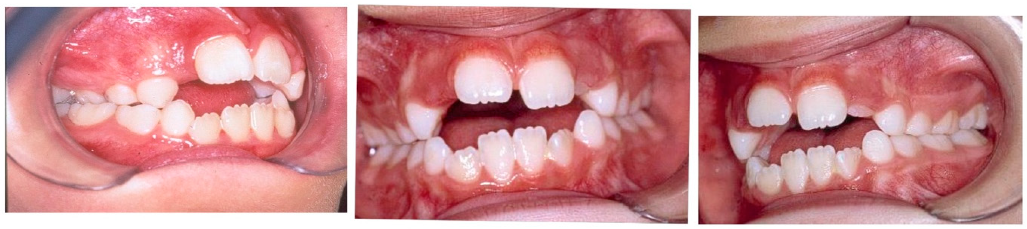 The Role of Digit- and Pacifier-Sucking Habits on Malocclusion ...