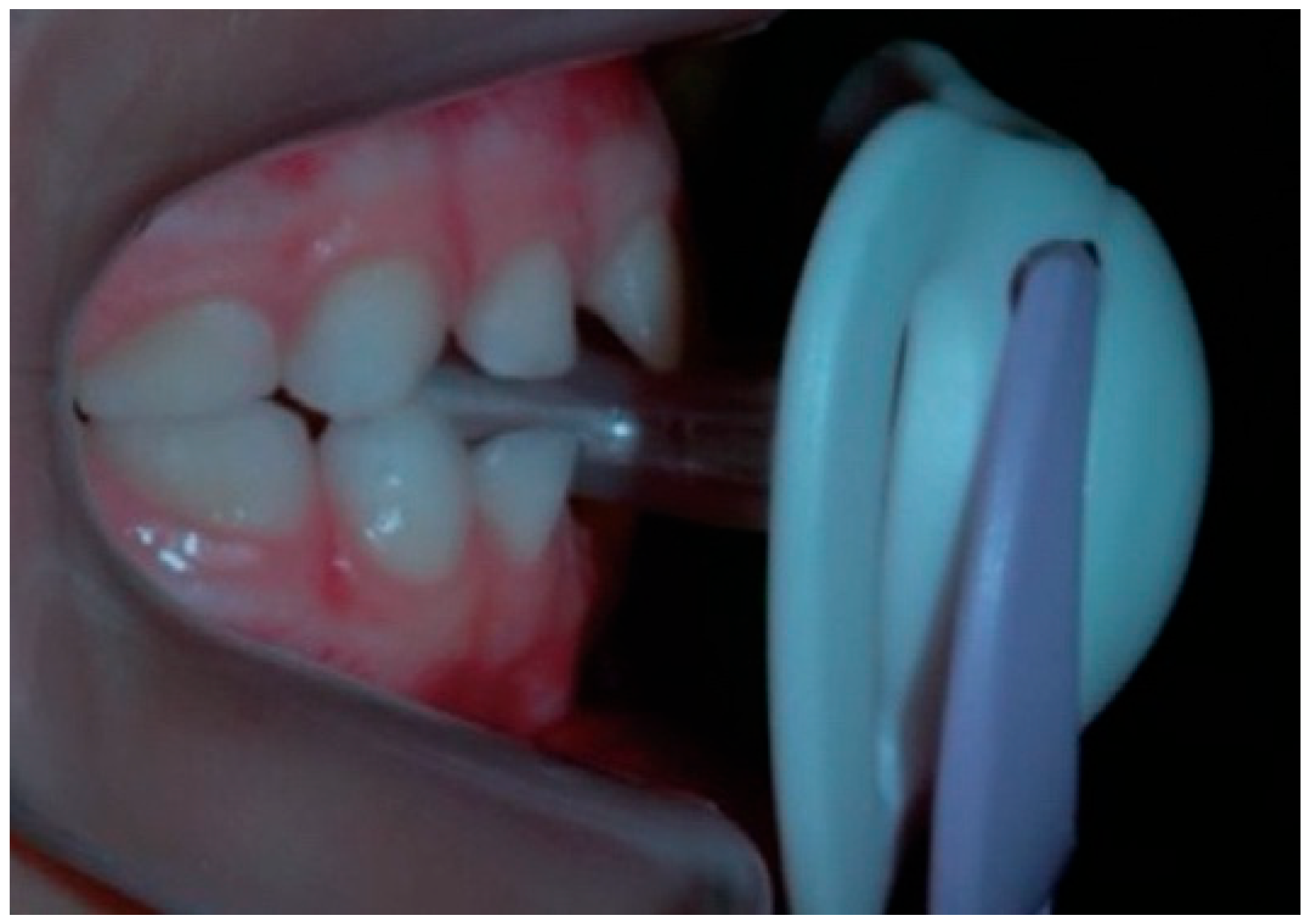The Role of Digit- and Pacifier-Sucking Habits on Malocclusion ...