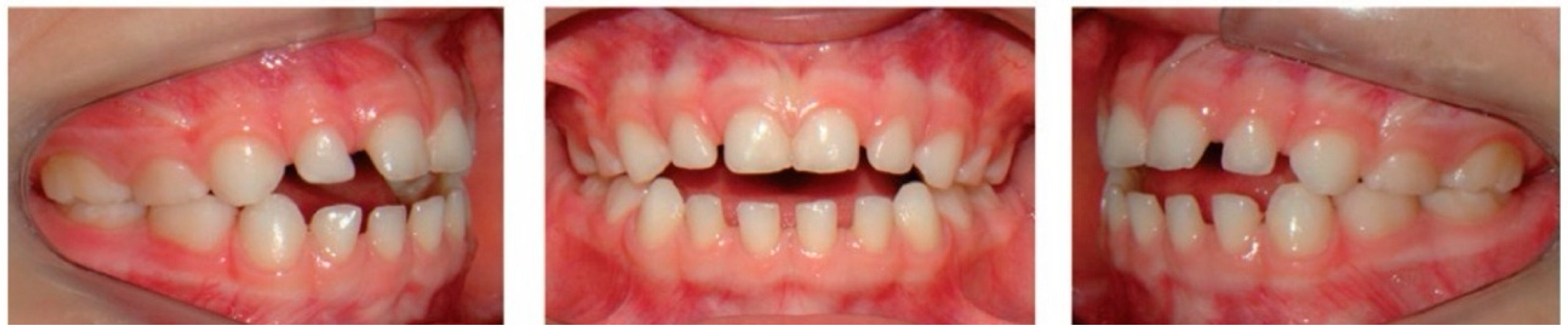 The Role of Digit- and Pacifier-Sucking Habits on Malocclusion ...