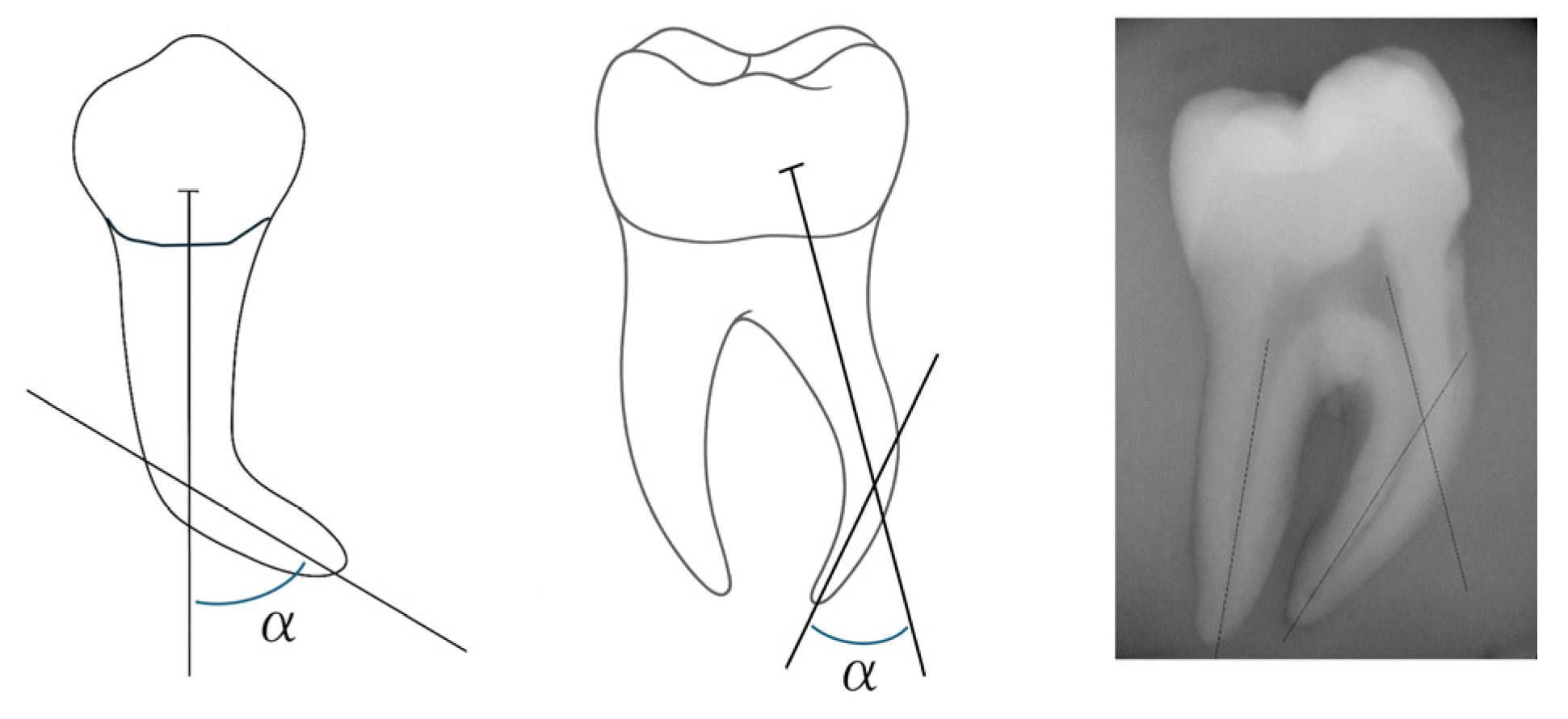 Comparative Analysis of Rotary Systems in Curved Root Canals ...