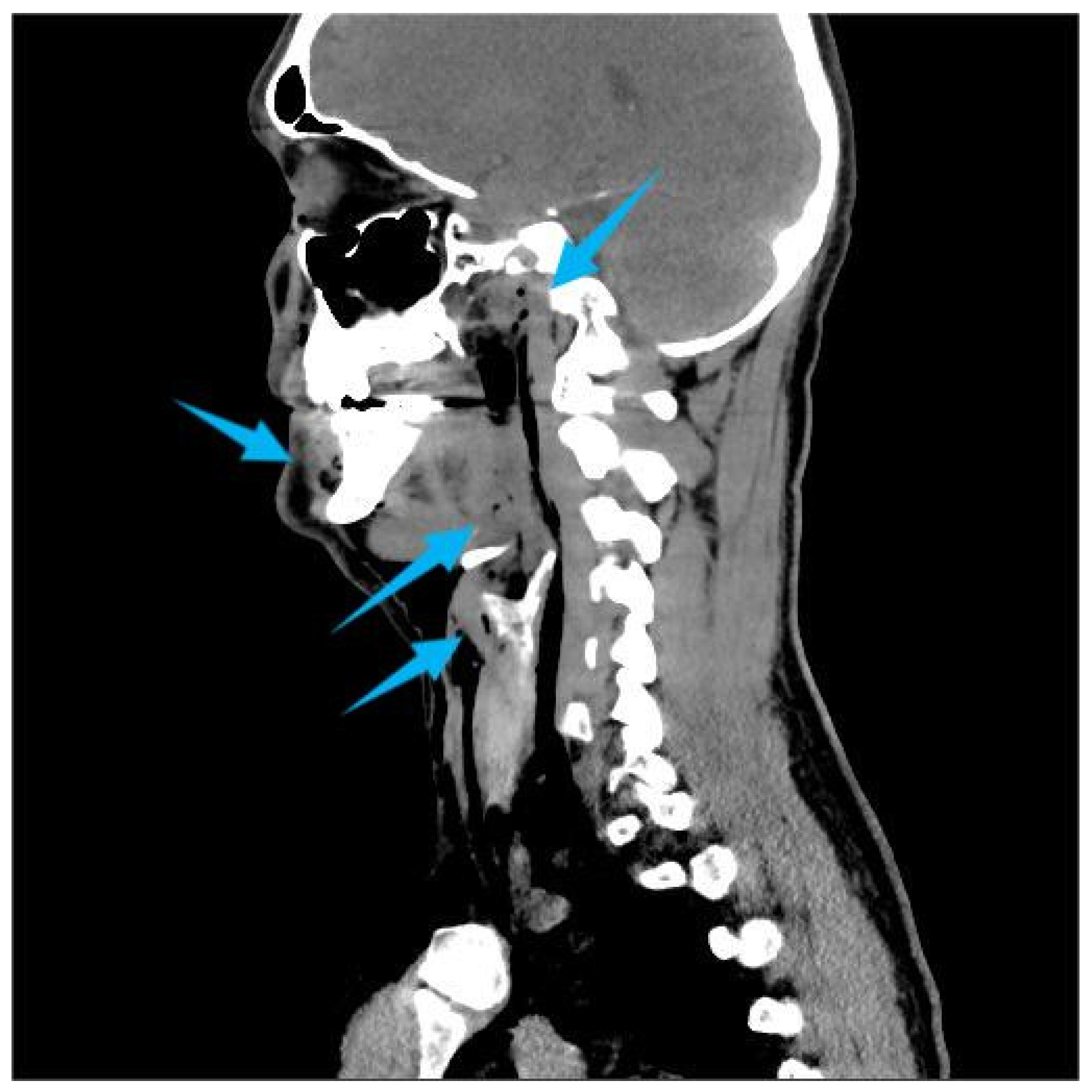 Voice Change Following Third Molar Alveolectomy: A Rare and Preventable ...