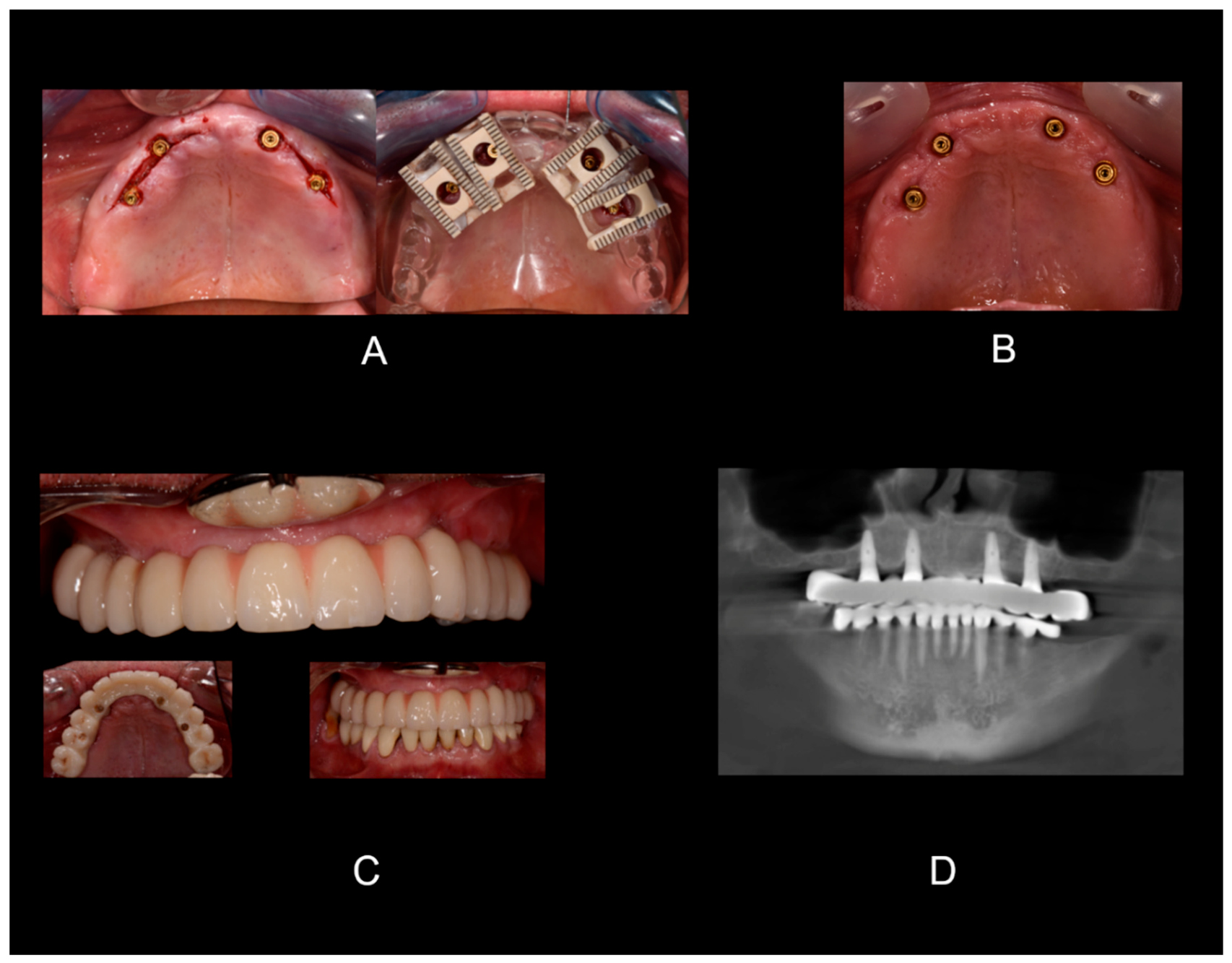 Prosthesis-Based 3D Guide System for Maxillary Implant Placement: A ...