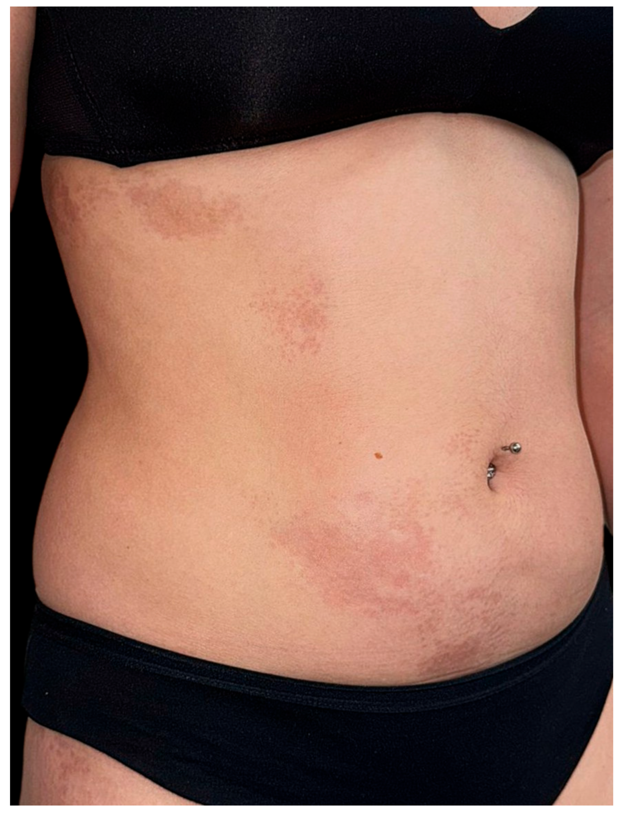 Linear Atrophoderma of Moulin: A Rare Blaschkoid Dermatosis