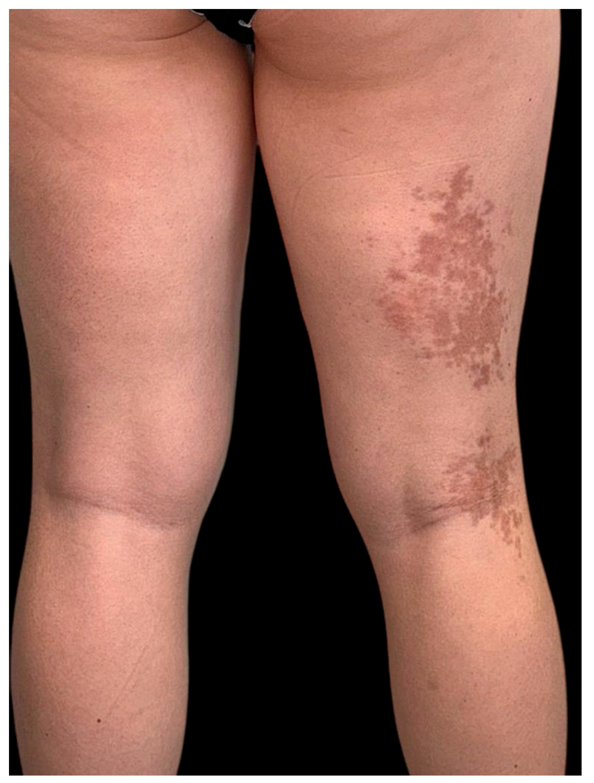 Linear Atrophoderma of Moulin: A Rare Blaschkoid Dermatosis