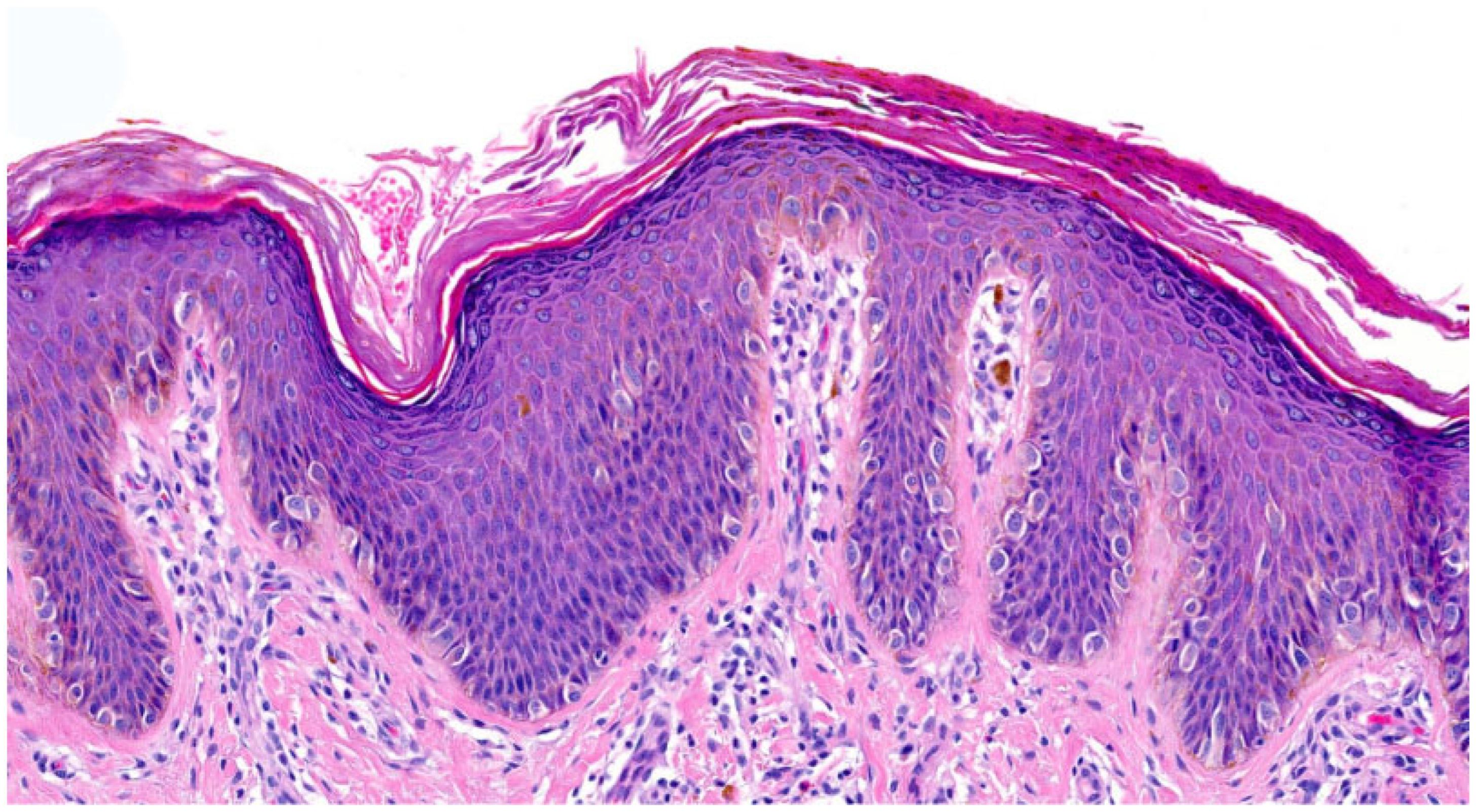 Defining Histological Patterns in Inherited Ichthyoses: Toward a ...