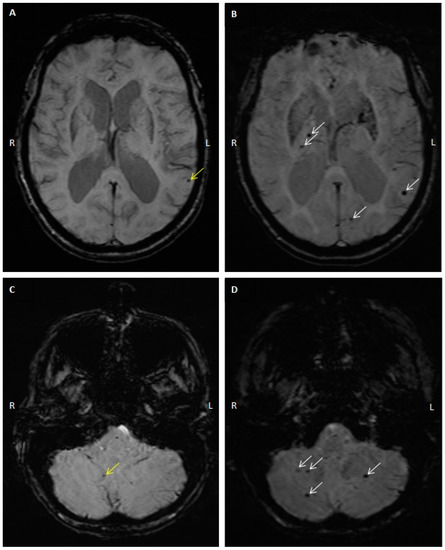 Cerebral Microbleeds in a Stroke Prevention Clinic