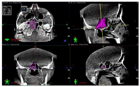 Intraoperative Sphenoid Sinus Volume Measurement as an Alternative ...