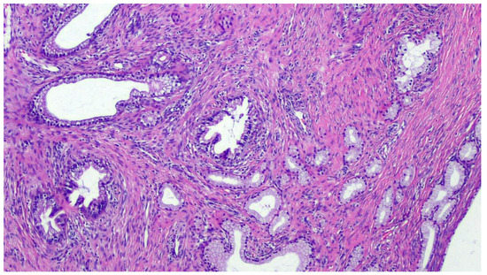 HPV-Negative Cervical Cancer: A Narrative Review
