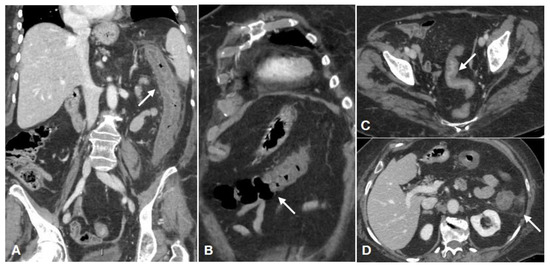 Large Bowel Ischemia/Infarction: How to Recognize It and Make ...