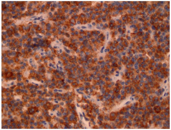 Somatostatin Receptor Subtype Expression in Patients with Acromegaly ...