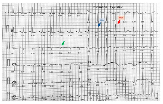 Usefulness of the Electrocardiogram in a Patient Presenting with Right ...