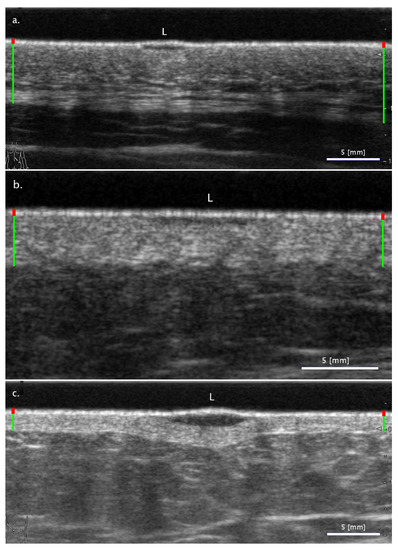 Automated Skin Lesion Classification on Ultrasound Images