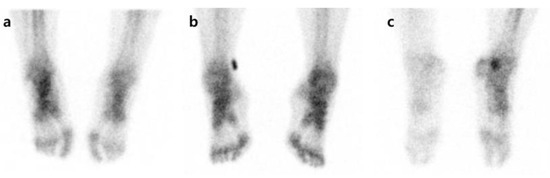 Diagnostic Performance of Three-Phase Bone Scintigraphy and Digital ...