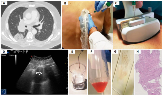 Effectiveness and Safety of Transthoracic Ultrasound in Guiding ...
