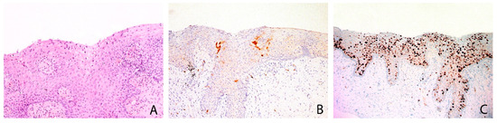 Predictive Role of the p16 Immunostaining Pattern in Atypical Cervical ...