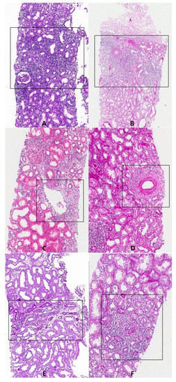 Multiplex Immunofluorescence Assay of Infiltrating Mononu-Clear Cell ...