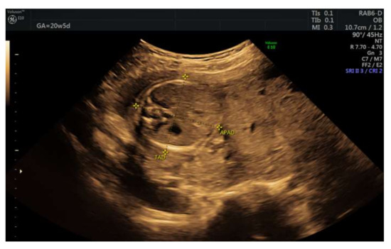 A Challenging Diagnosis: Placental Mesenchymal Dysplasia—Literature ...