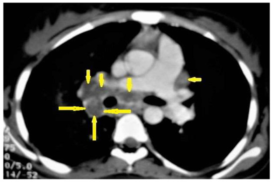 The Diagnostic Deceiver: Radiological Pictorial Review of Tuberculosis