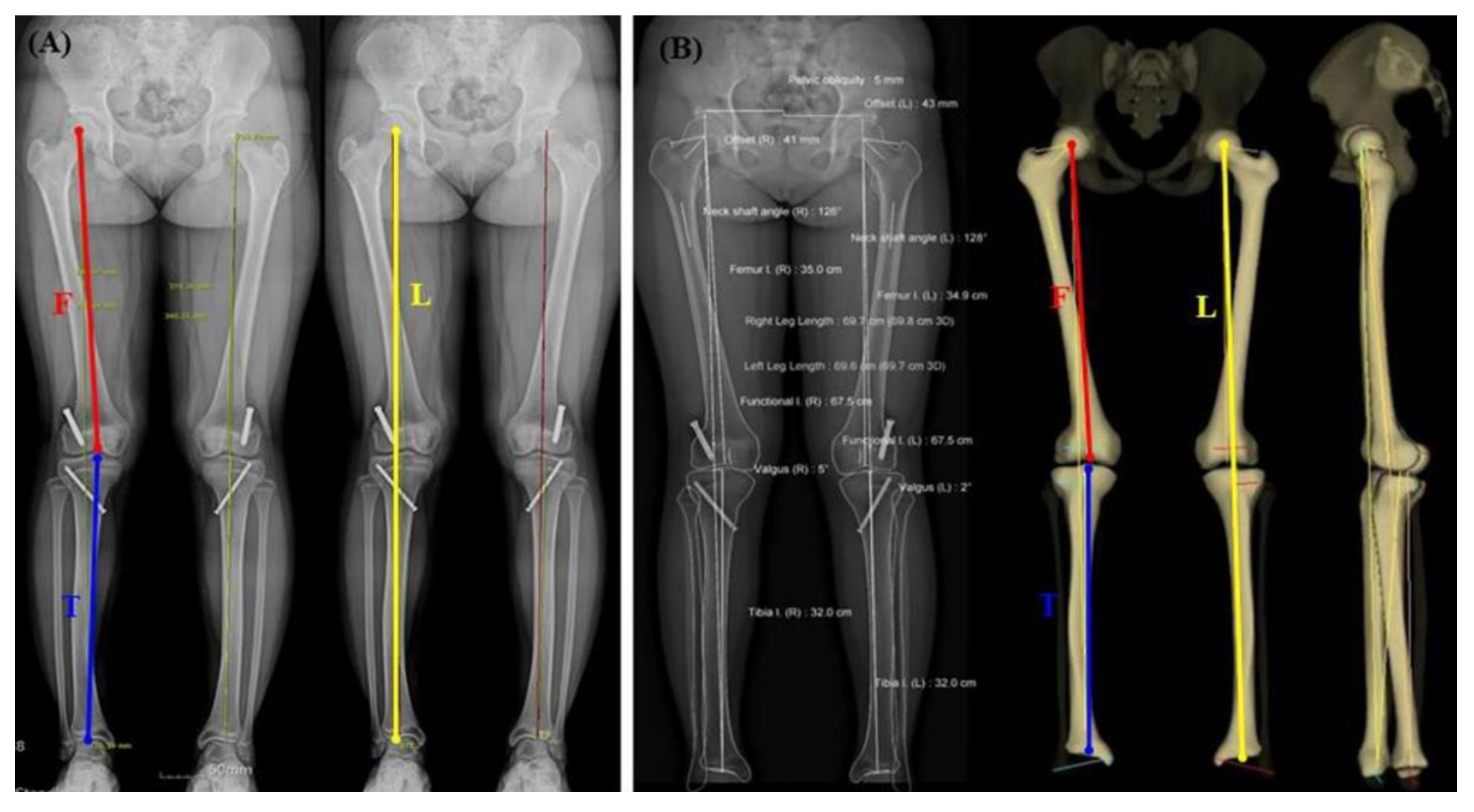 Diagnostics Free Full Text The Comparison Of Lower Extremity Length Diagnostics Free Full Text The Comparison Of Lower Extremity Length