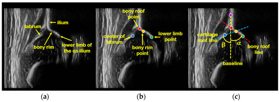 Development of a Fully Automated Graf Standard Plane and Angle ...