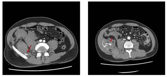 Retroperitoneal Hematoma Caused by Lumbar Artery Injury during ...