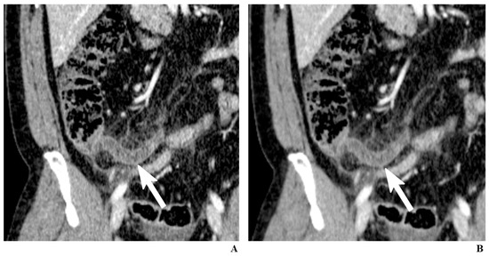 Low-Dose Abdominal CT for Evaluating Suspected Appendicitis ...