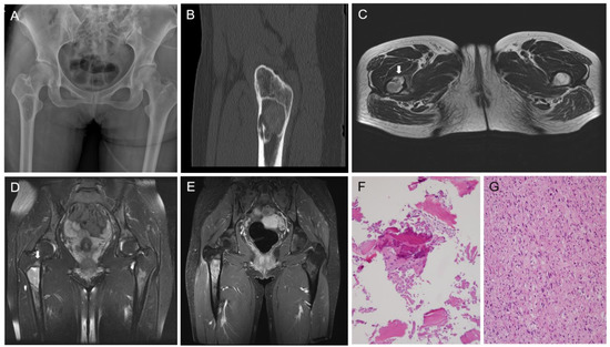 Osteosarcoma Arising in Fibrous Dysplasia of the Long Bone: Characteristic Images and Molecular ...