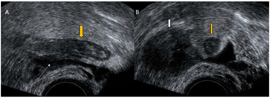 Extra-Gynecological Pelvic Pathology: A Challenge in the Differential ...