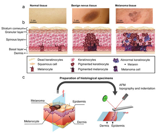 Diagnostics | Free Full-Text | Melanoma Detection by AFM Indentation of ...