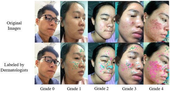 Automatic Acne Object Detection and Acne Severity Grading Using Smartphone Images and Artificial ...