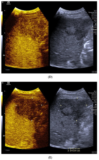 Diagnostics | Special Issue : Contrast Enhanced Ultrasound ...