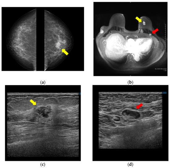 Focal Uptake in the Sternum on 18F-FDG-PET/CT Caused by G-CSF Therapy ...