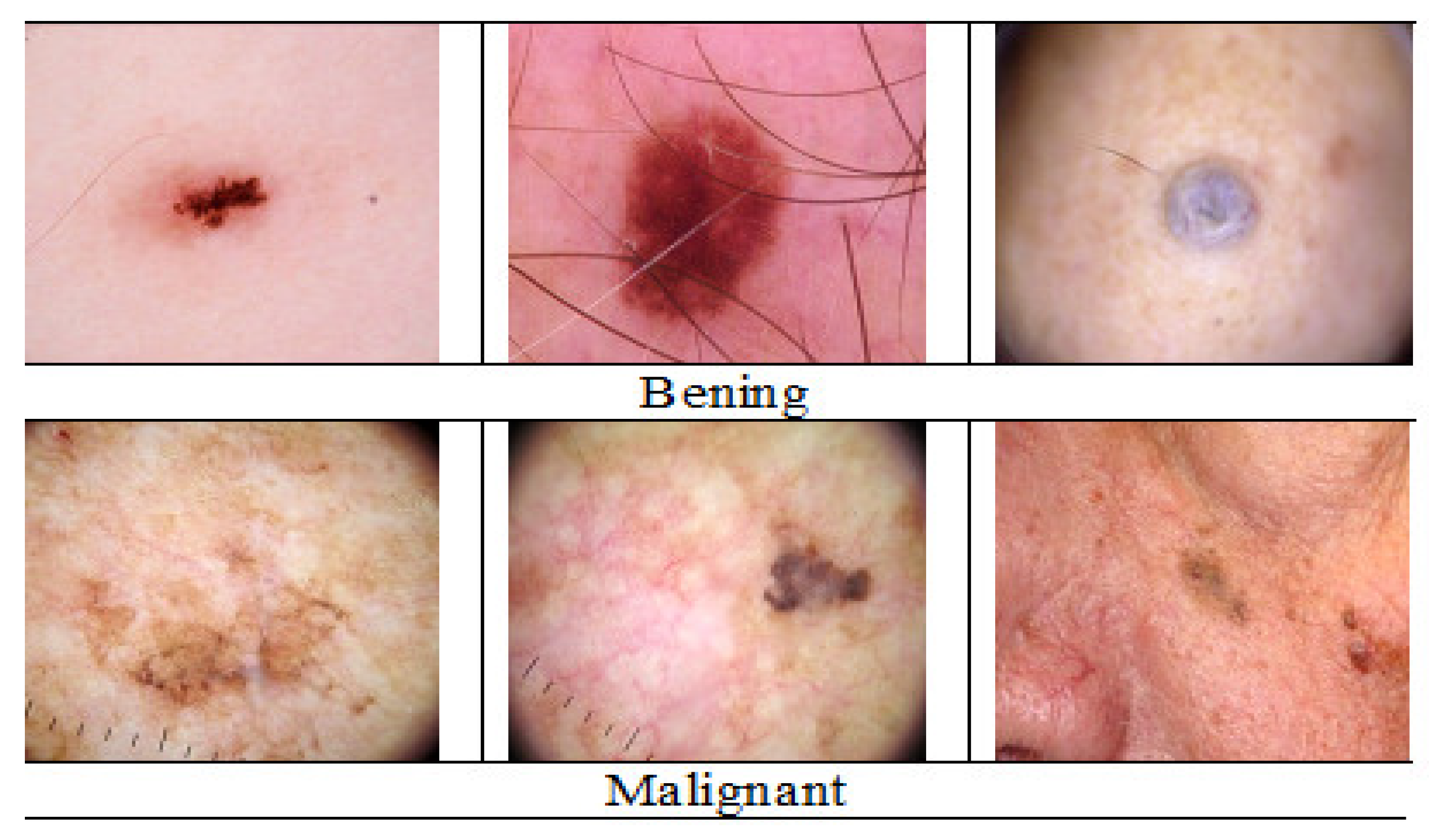 Benign Tumor Skin Benign Tumor Skin