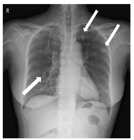 Septic Pulmonary Emboli Detected by 18F-FDG PET/CT in a Patient with ...