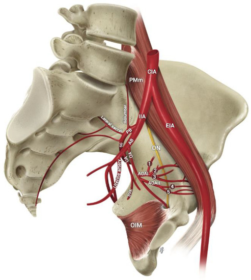 A Bipartite Obturator Artery with Multiple Pelvic Branching—A ...