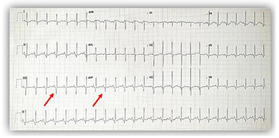 Challenging Diagnosis of Anomalous Origin of the Right Coronary Artery ...