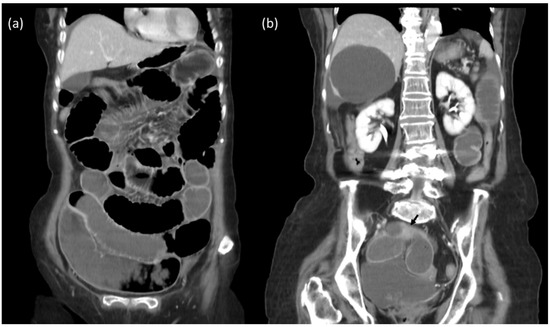 Appendiceal Mucinous Tumor Presenting as Recurrent Bowel Obstruction