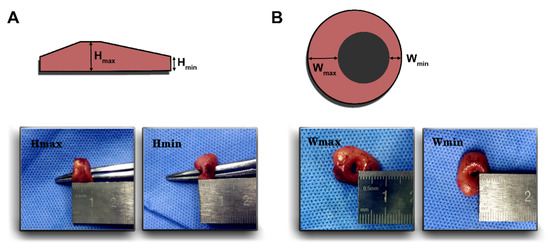 Anastomotic Rings and Inflammation Values as Biomarkers for Leakage of ...