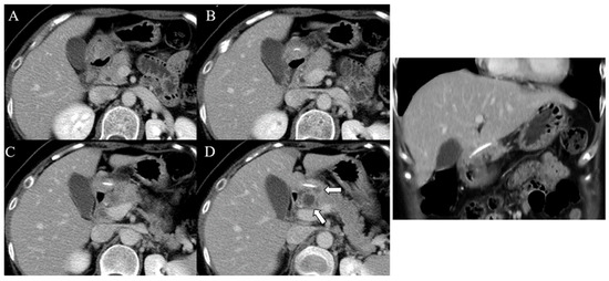 Unusual Pancreatic Abscess Secondary to Embedded Fish Bone: A ...