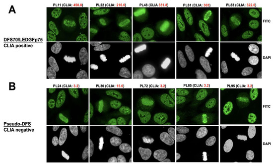 The Nuclear Dense Fine Speckled (DFS) Immunofluorescence Pattern: Not ...